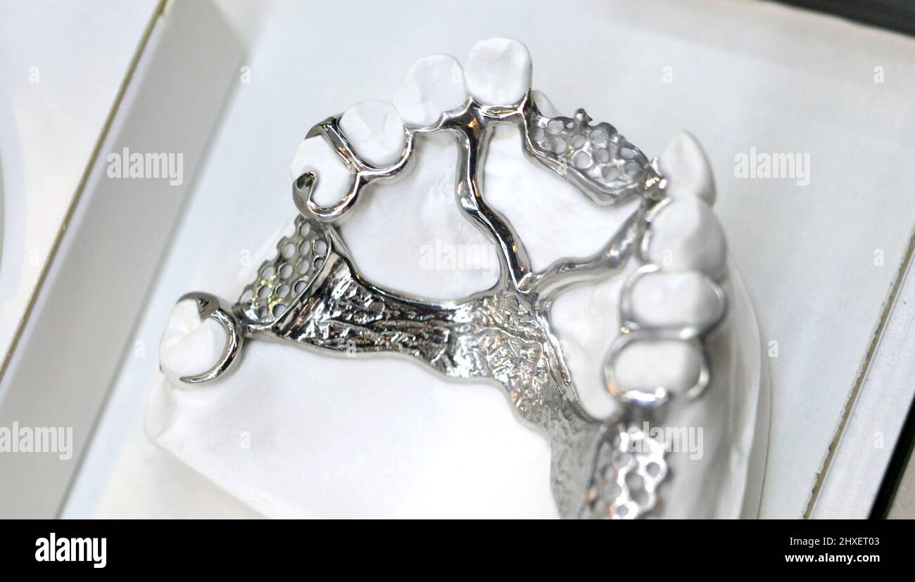 Implantation implantat hi-res stock photography and images - Alamy