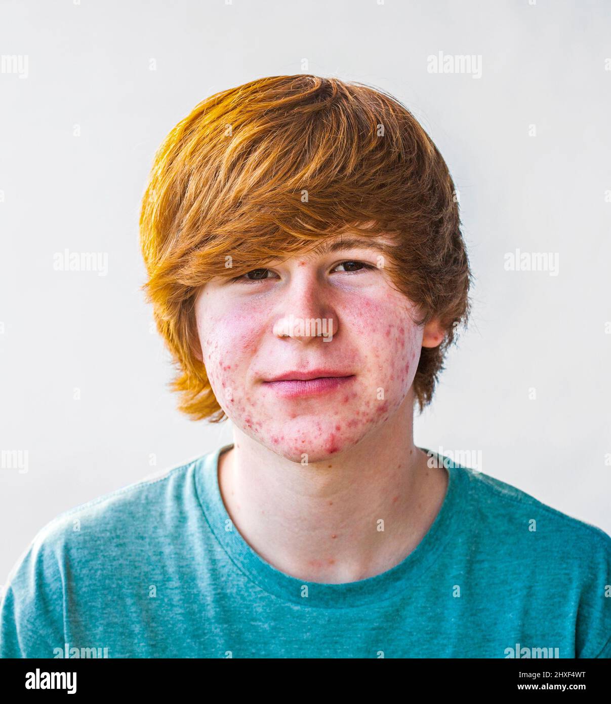 smart happy boy in puberty with acne Stock Photo - Alamy