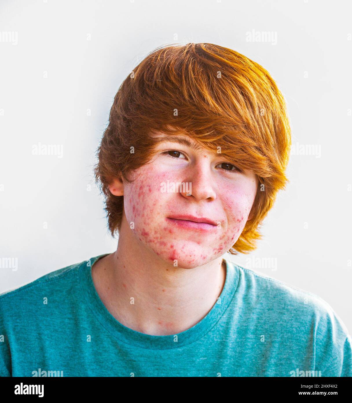 Kid acne hi-res stock photography and images - Alamy
