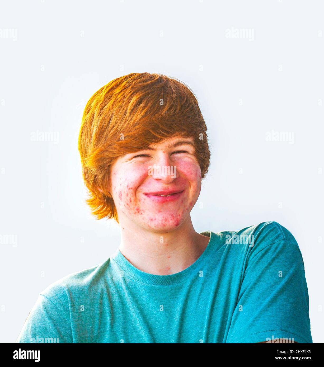 smart happy boy in puberty with acne Stock Photo - Alamy