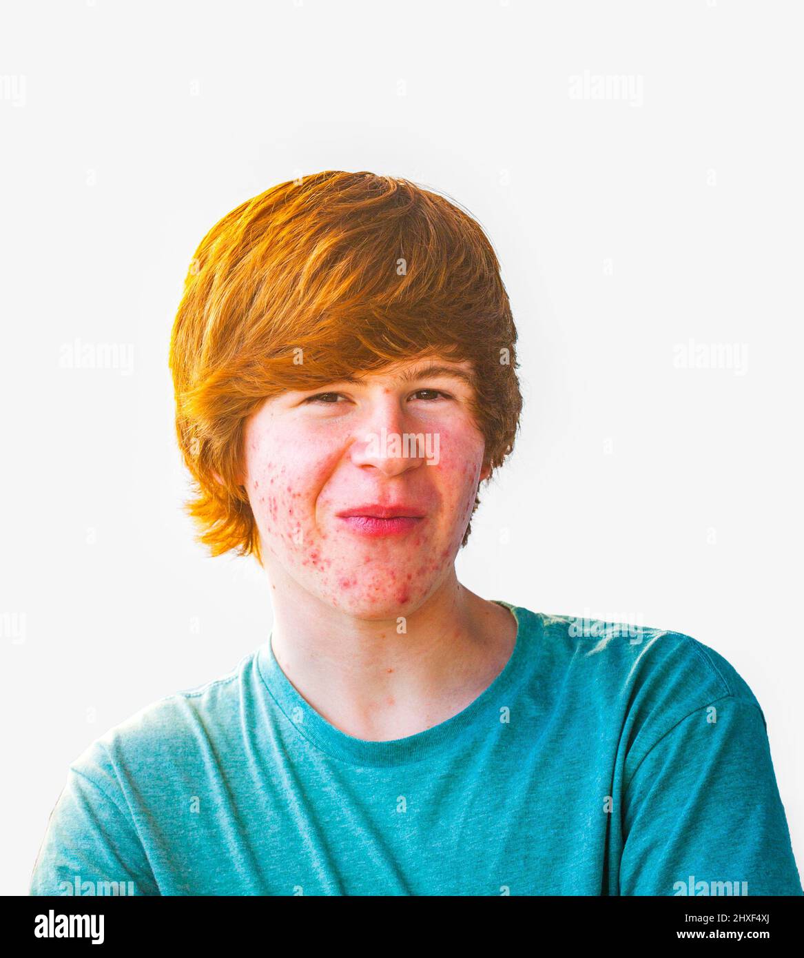 smart happy boy in puberty with acne Stock Photo - Alamy