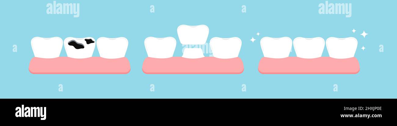Teeth multiple caries, crown stage in gym before and after dental icon ...