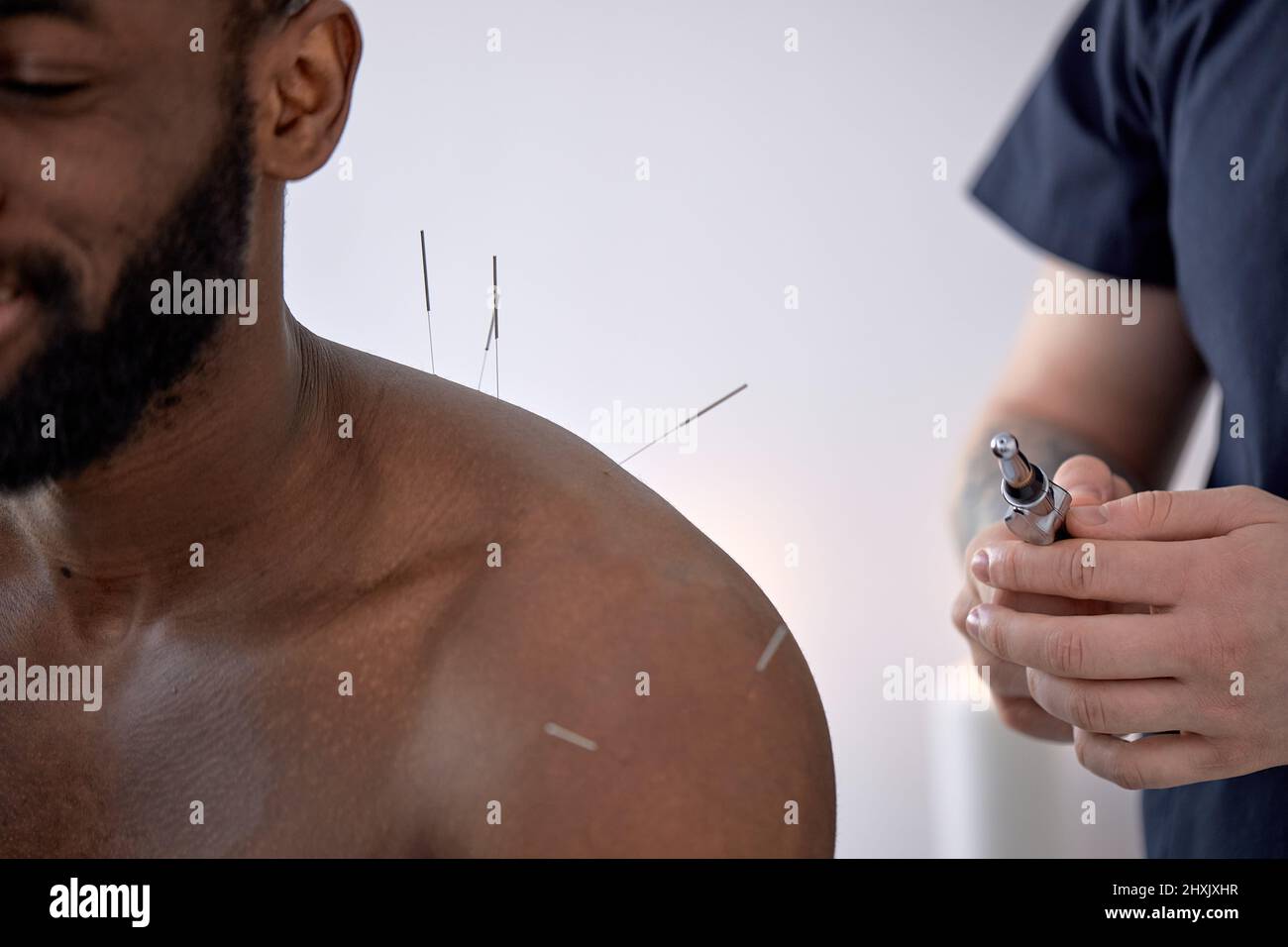 male doctor sticks needles into black male body on the acupuncture ...