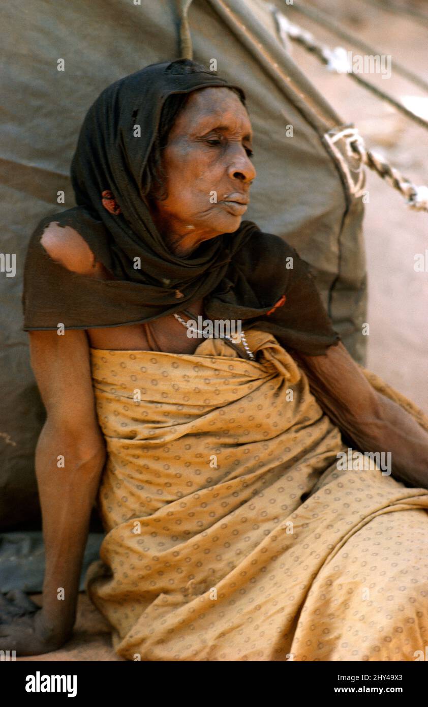 Leprosy disease hi-res stock photography and images - Alamy