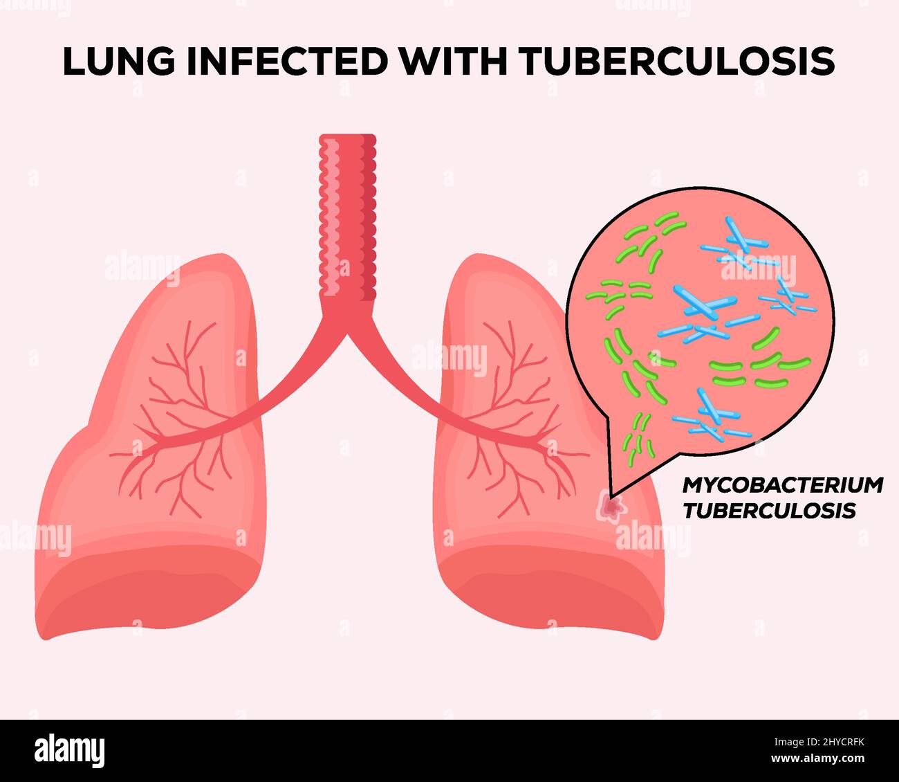 Pulmonary tuberculosis Stock Vector Images - Alamy
