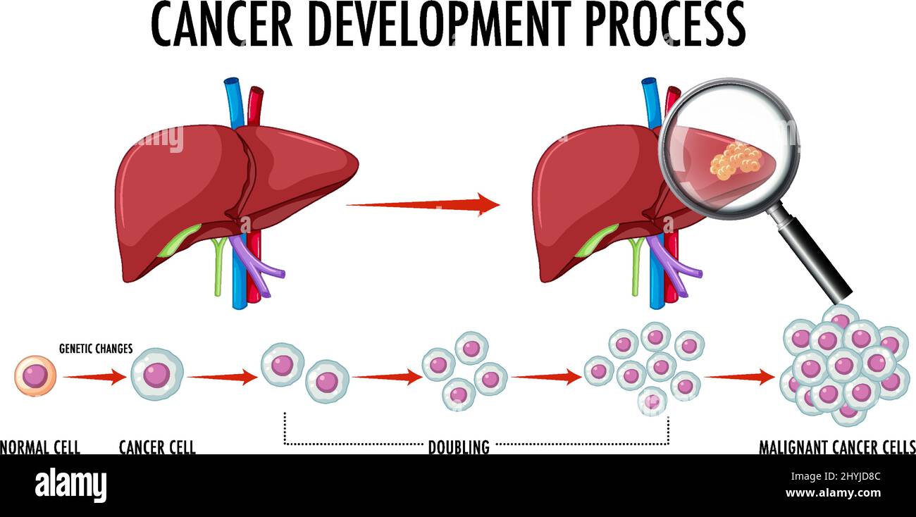 Diagram showing cancer development process illustration Stock Vector ...
