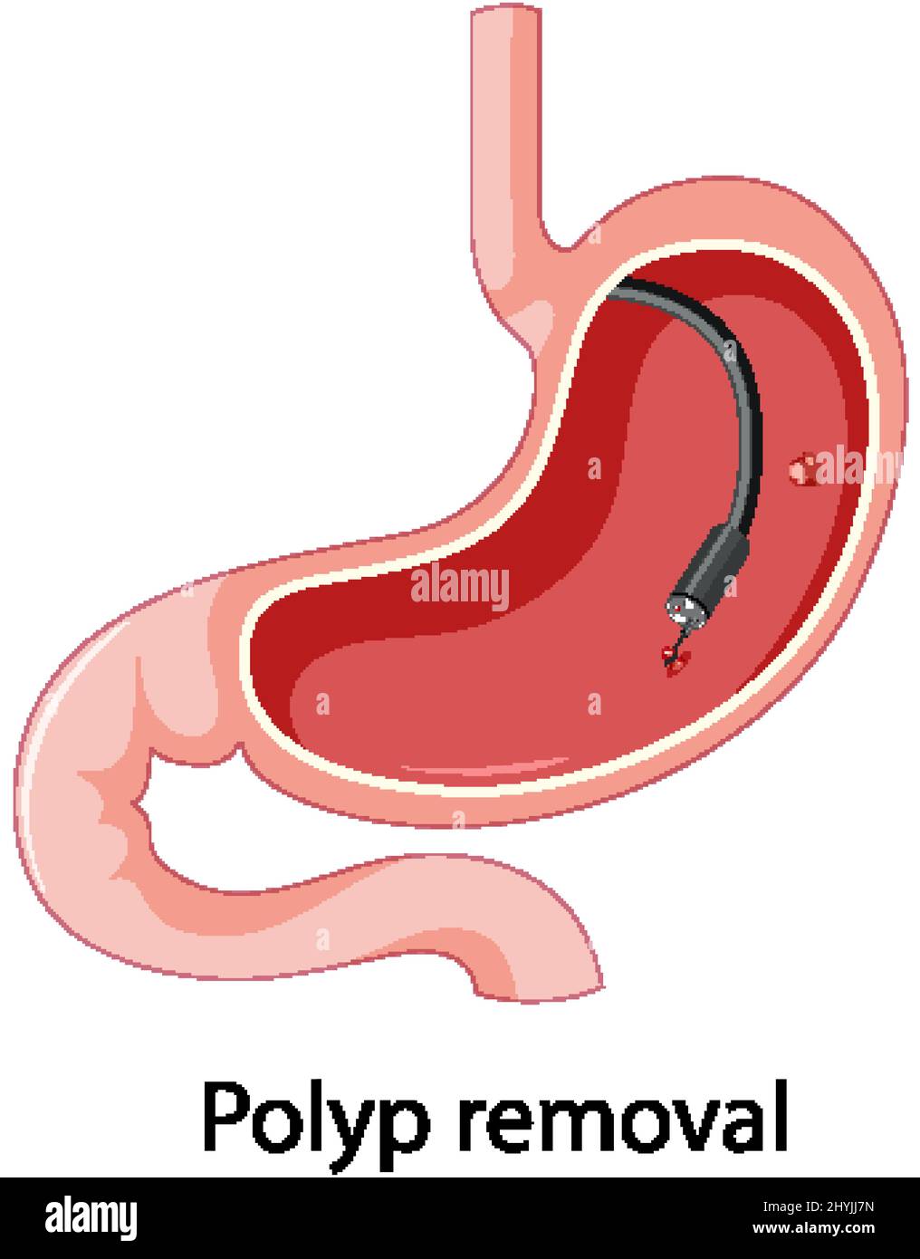 Diagram showing polyp removal in human illustration Stock Vector Image ...