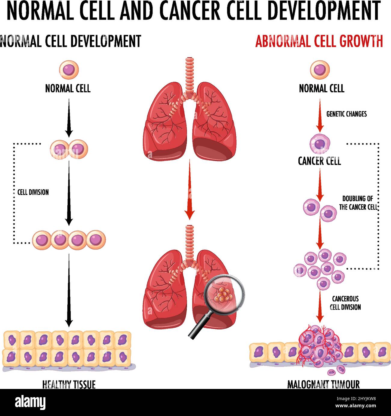 Diagram showing normal and cancer cells in human illustration Stock ...