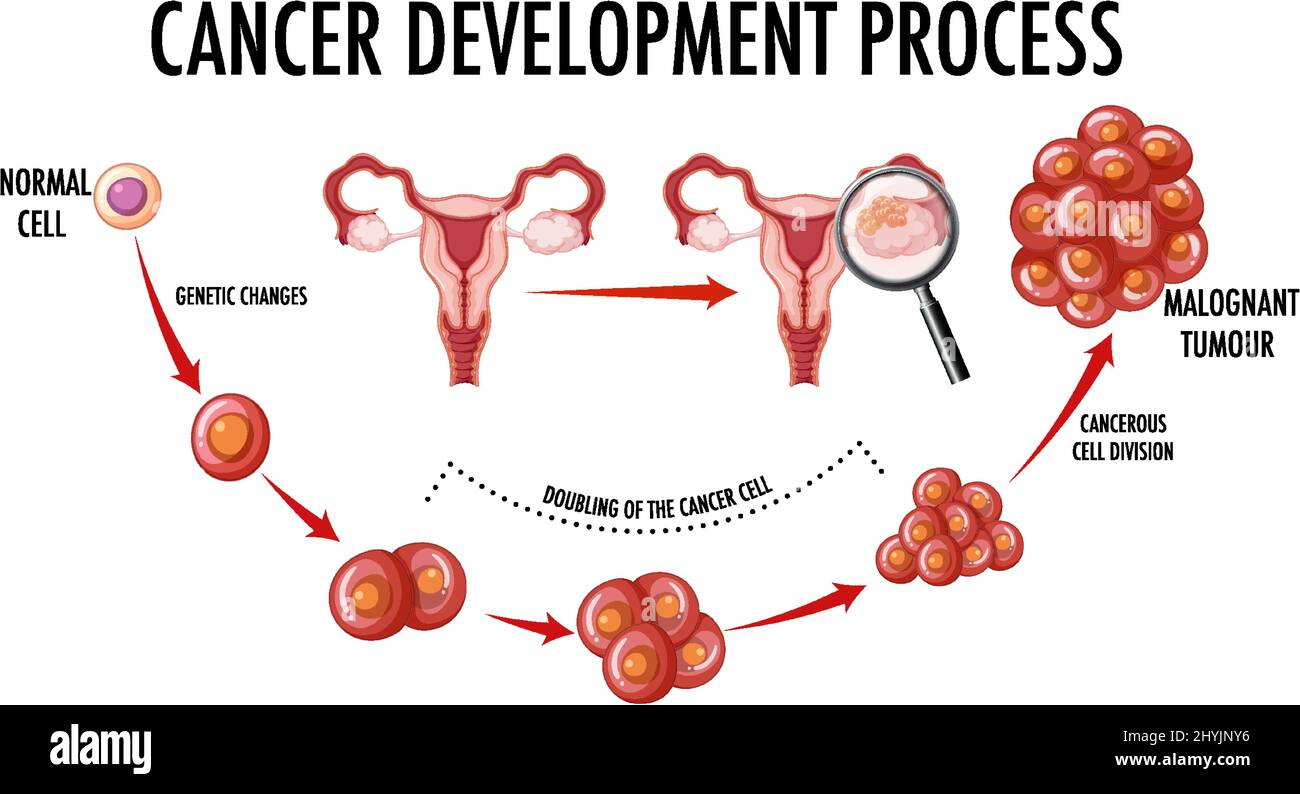 Diagram showing cancer development process illustration Stock Vector ...