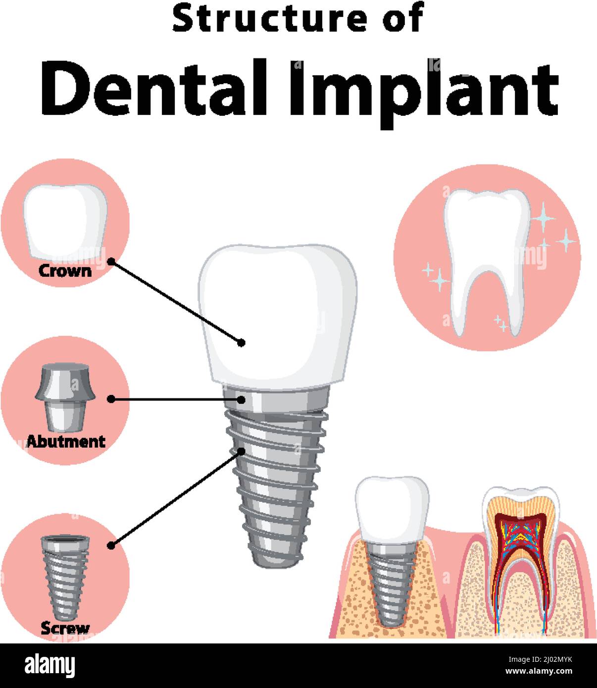 Infographic of human in structure of the dental implant illustration ...