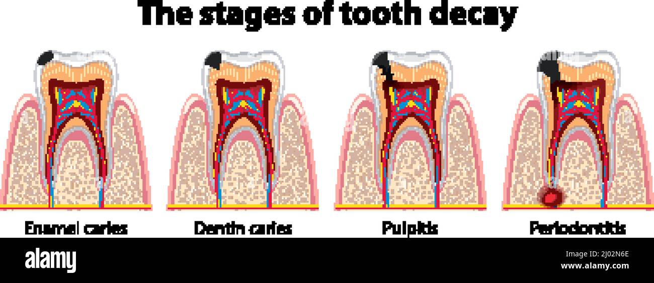 Infographic of human in the stages of tooth decay illustration Stock ...