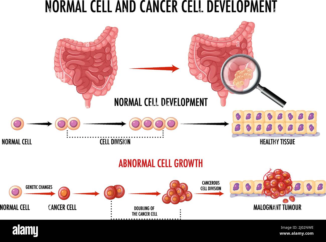 Diagram showing normal and cancer cells in human illustration Stock ...