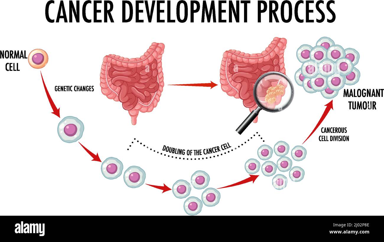 Diagram showing cancer development process illustration Stock Vector ...