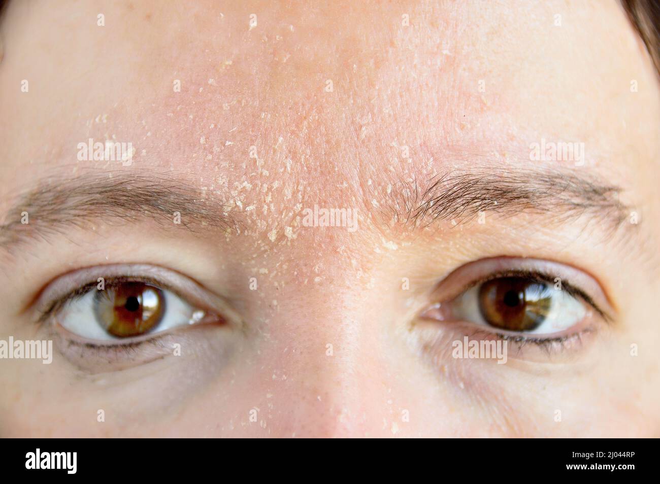 woman with symptom of atopic dermatitis on brow and brows Stock Photo ...