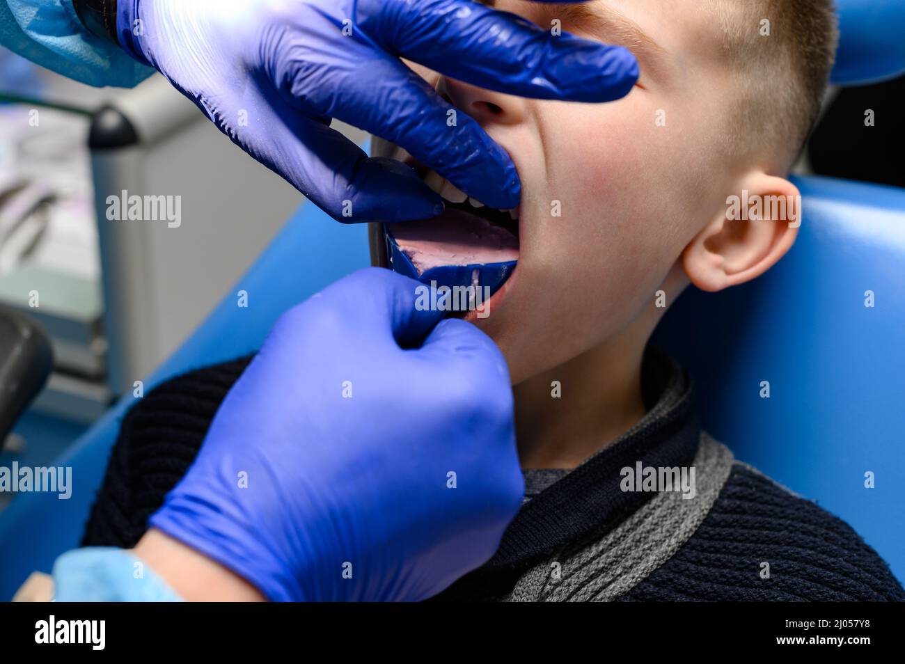 Jaw impression with a silicone diagnostic model, crooked teeth in a ...