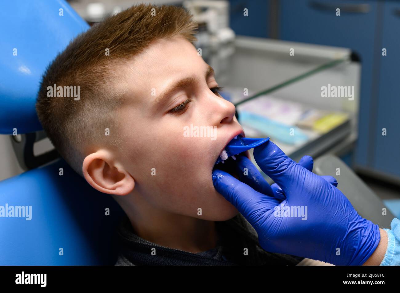 Jaw impression with a silicone diagnostic model, crooked teeth in a ...