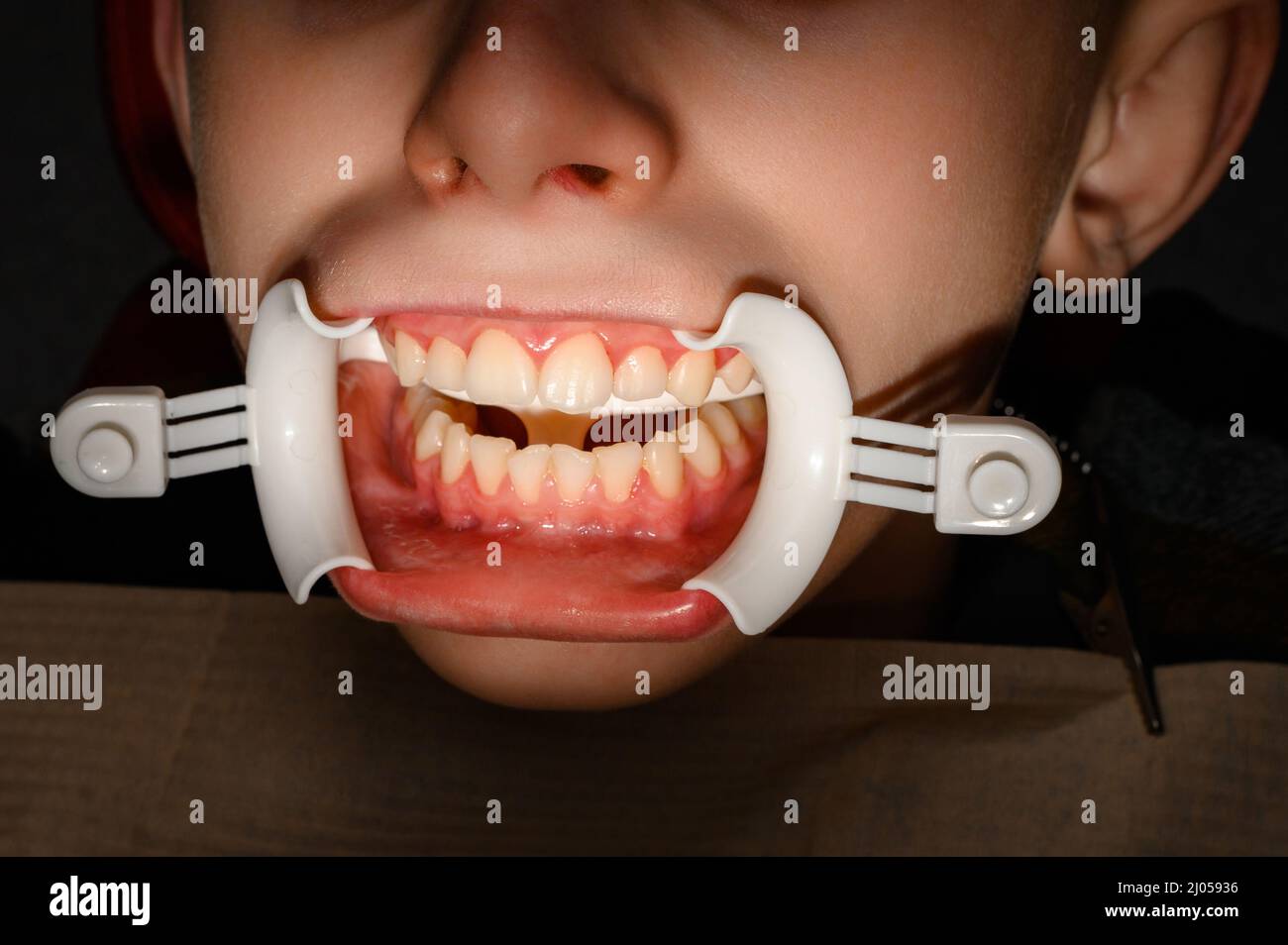 Plastic retractor for lip augmentation in the mouth, dental procedure ...