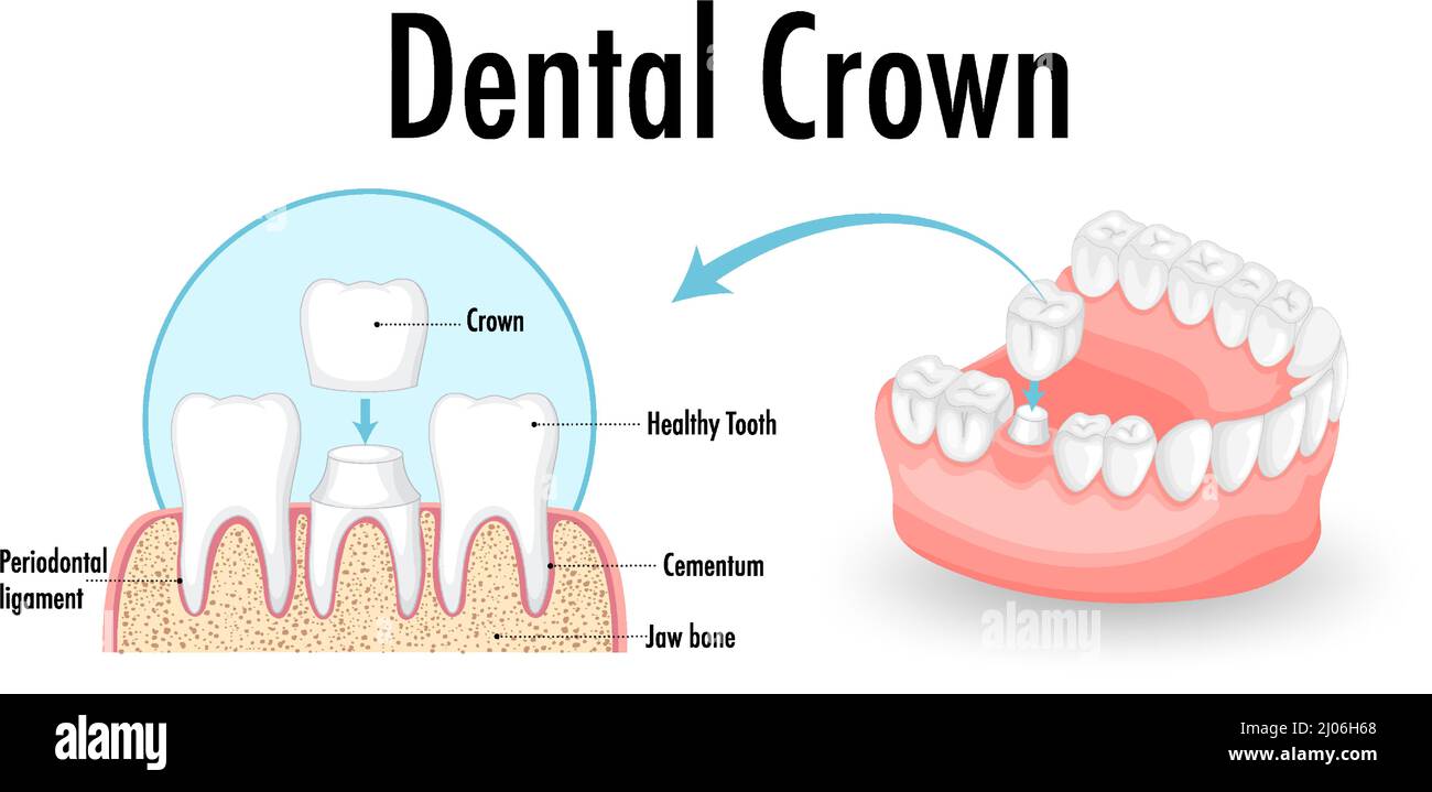 Infographic of human in dental crown illustration Stock Vector Image ...