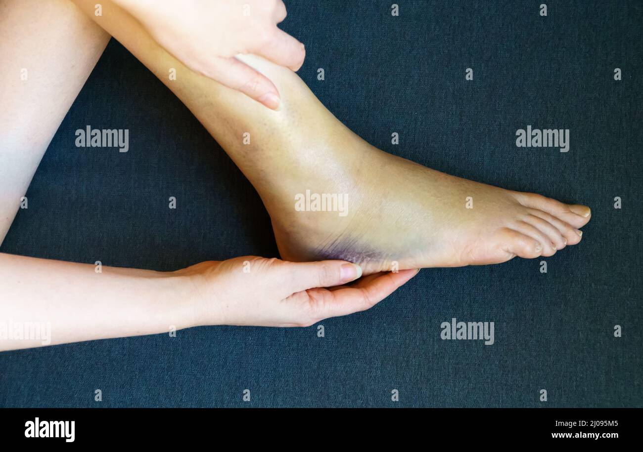 Female leg with bruises and swelling Stock Photo - Alamy