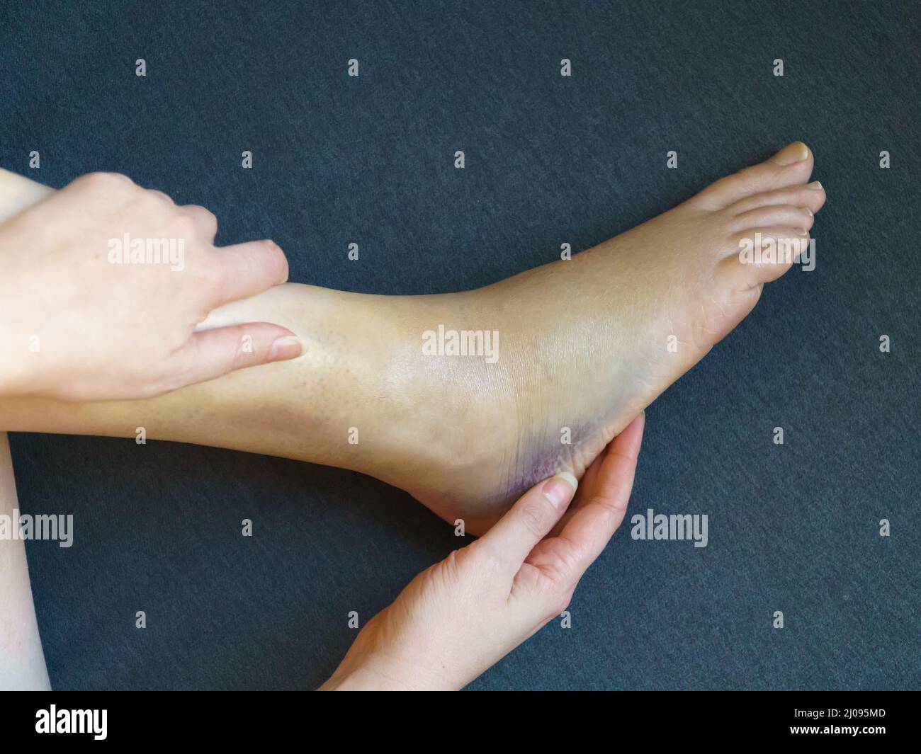 Female leg with bruises and swelling Stock Photo - Alamy