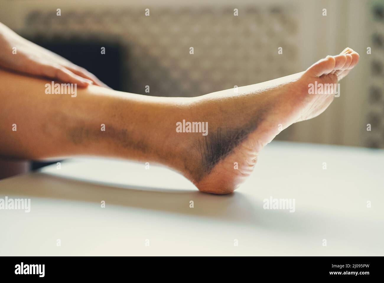 Bruise leg hi-res stock photography and images - Alamy
