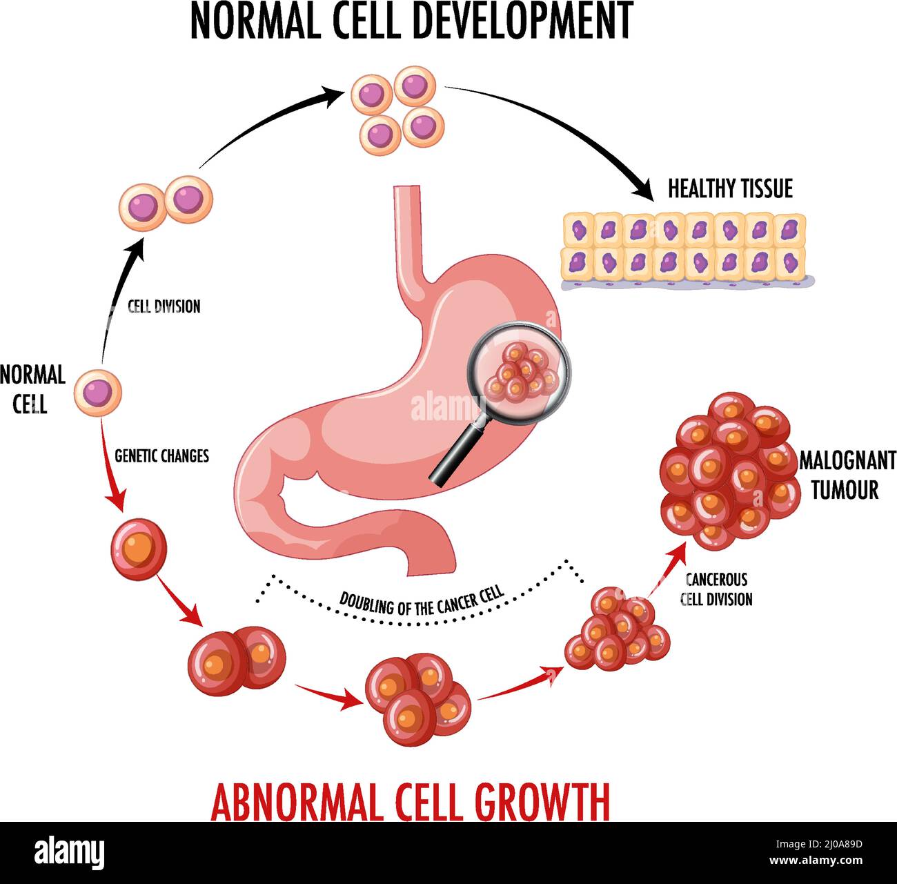 Diagram showing cancer in stomach illustration Stock Vector Image & Art ...