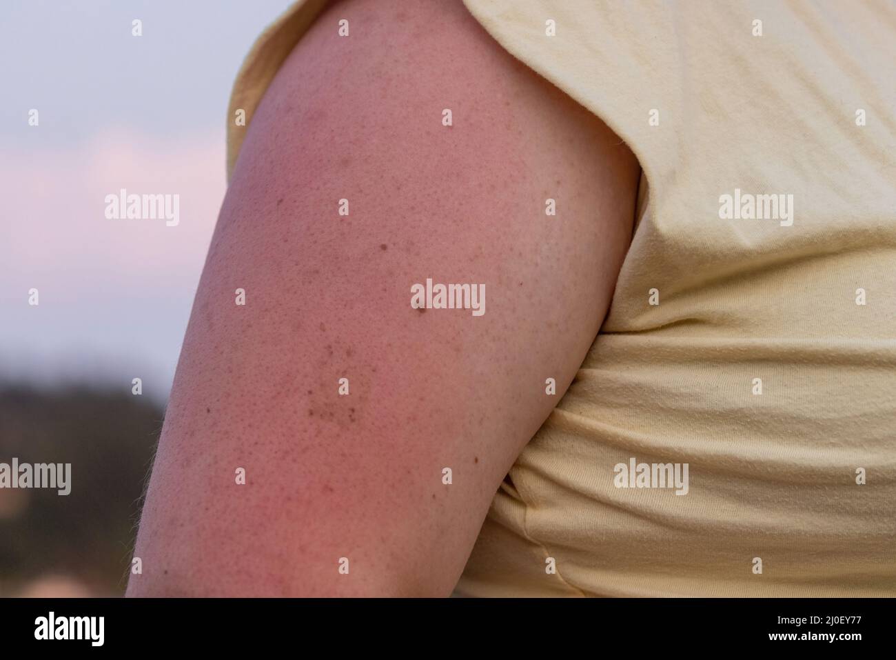 irritated sunburn on womans arm in summer with freckles Stock Photo - Alamy