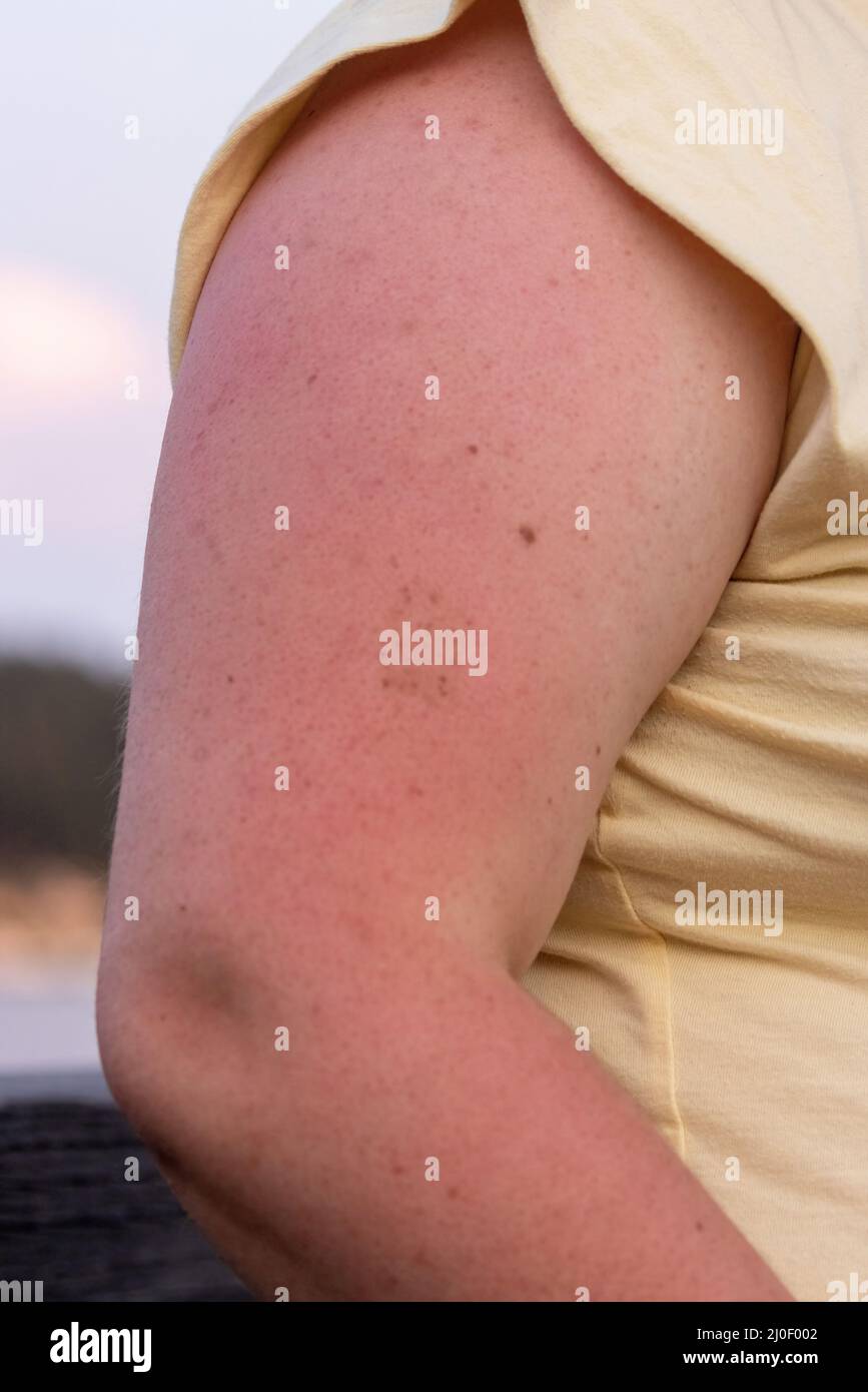 caucasian womans arm red from a sun burn in mid summer Stock Photo - Alamy