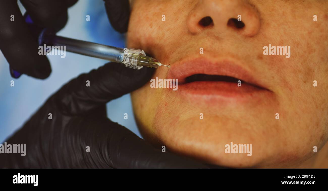Closeup woman lips, procedure augmentation. Syringe female mouth ...
