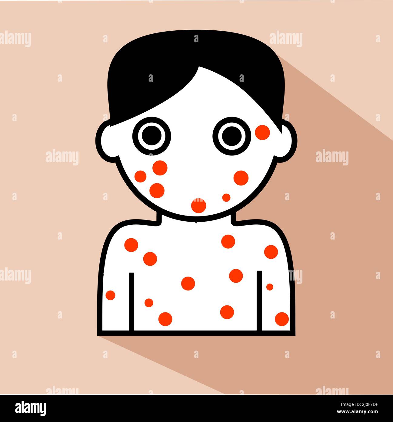 Flat illustration of chicken pox or smallpox, kid vector icon for web ...