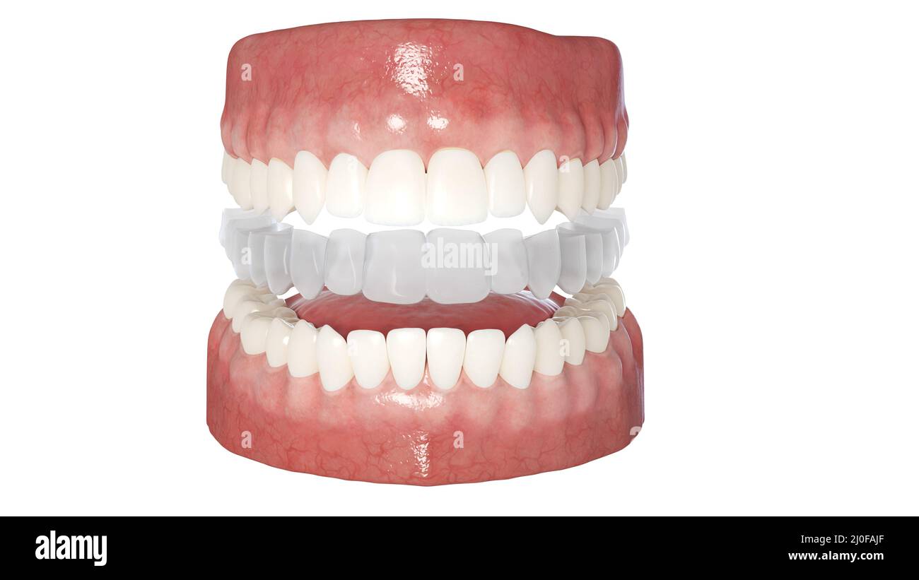 Clear dental aligner, illustration Stock Photo - Alamy