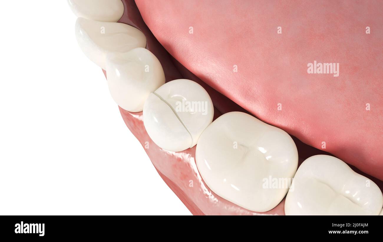 Broken tooth, illustration Stock Photo - Alamy