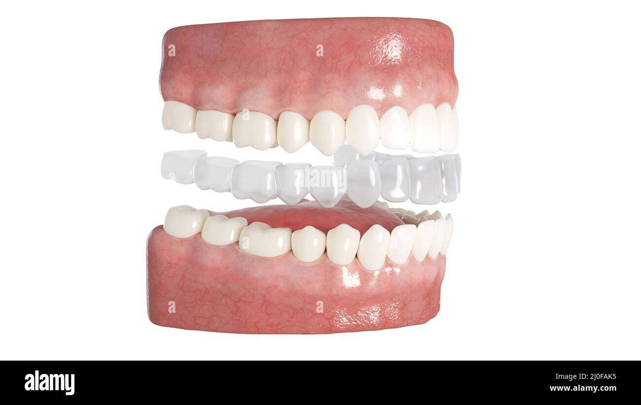 Clear dental aligner, illustration Stock Photo - Alamy