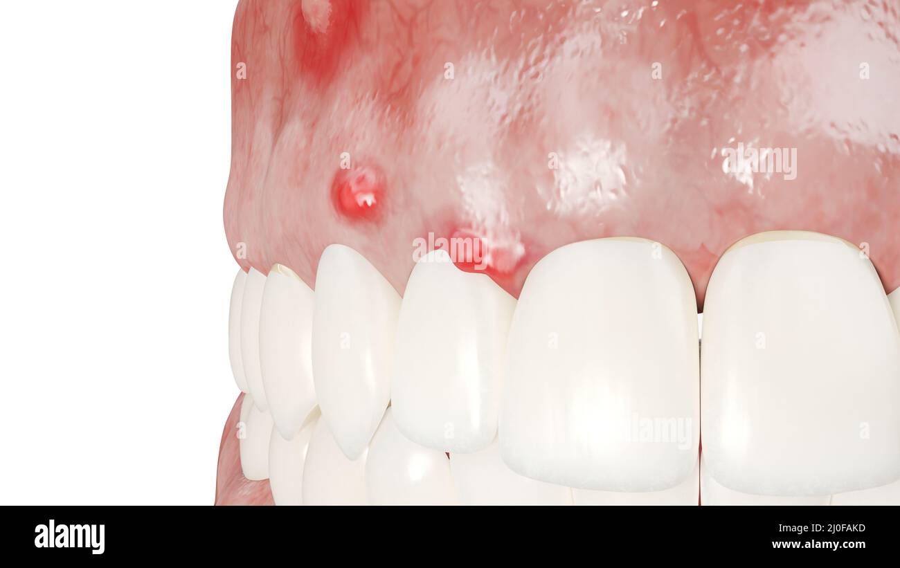 Dental abscess, illustration Stock Photo - Alamy