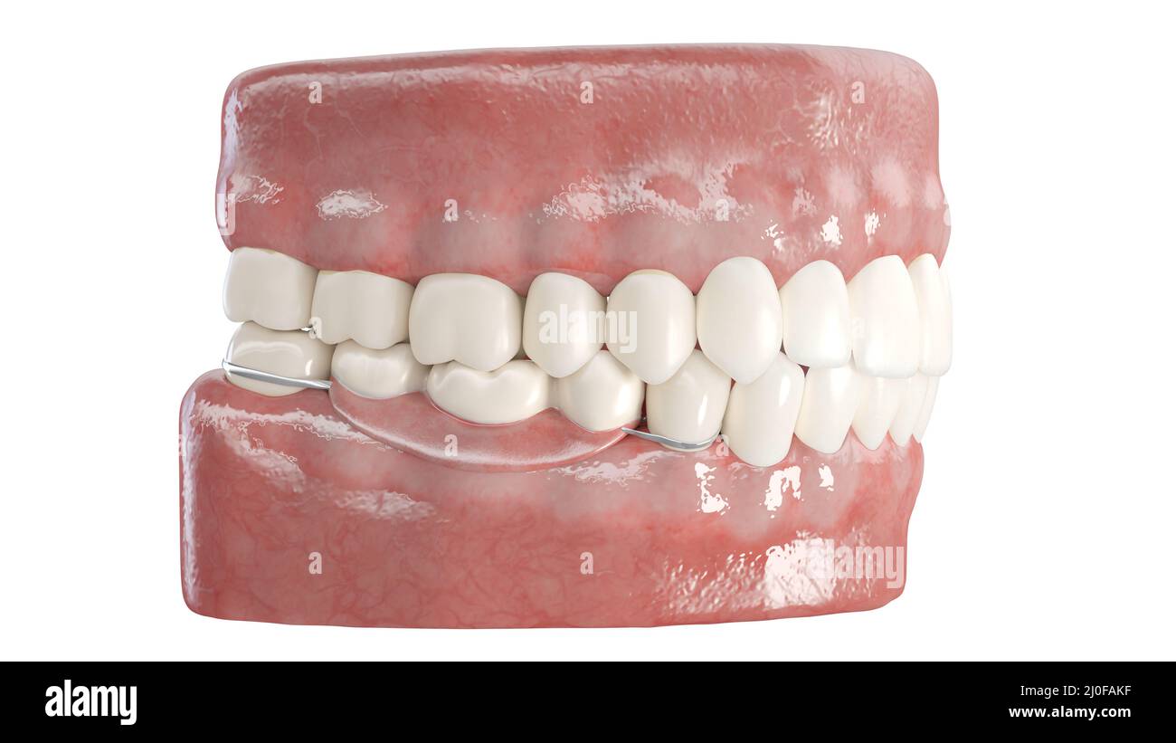 Denture illustration Cut Out Stock Images & Pictures - Alamy