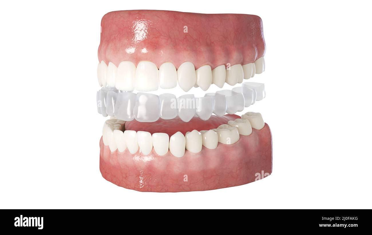 Clear dental aligner, illustration Stock Photo - Alamy