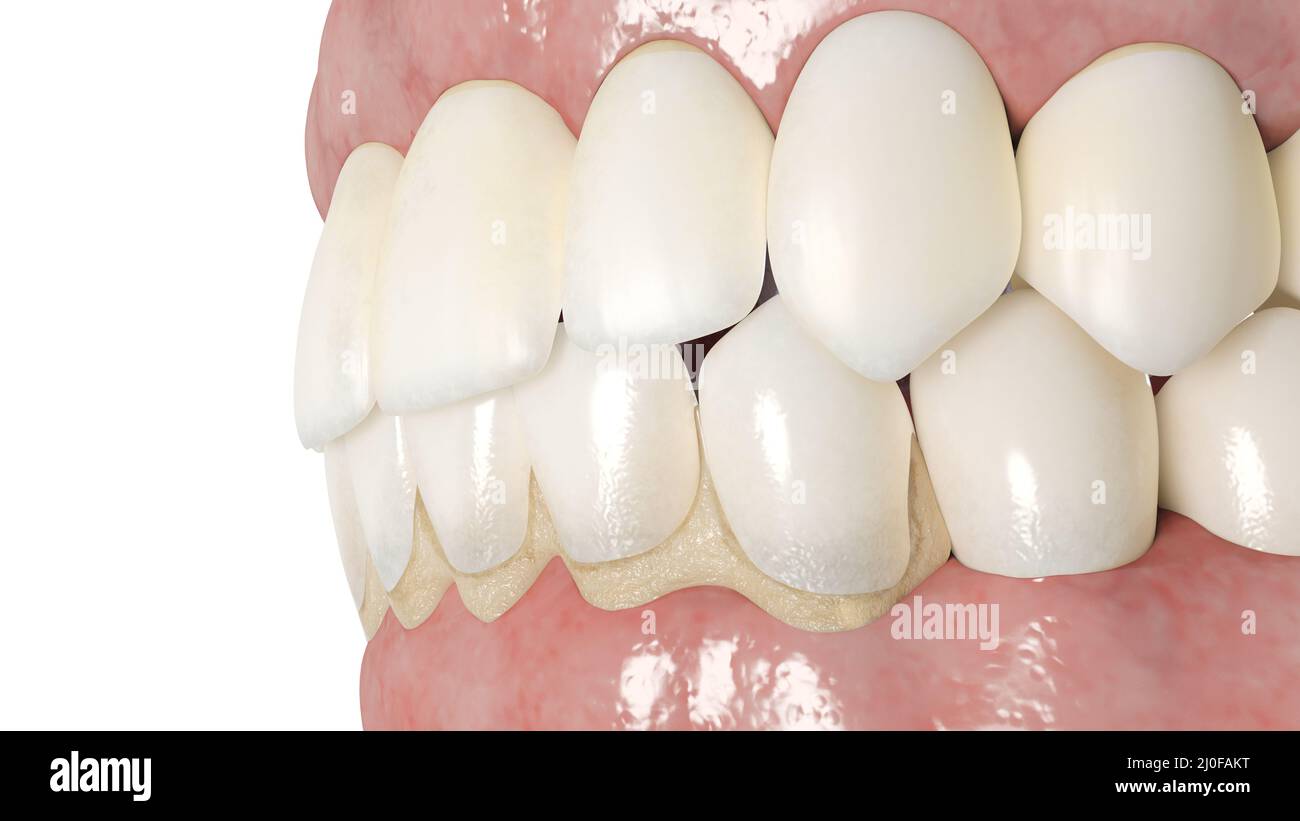 Heavy Dental Calculus Gastrostomy