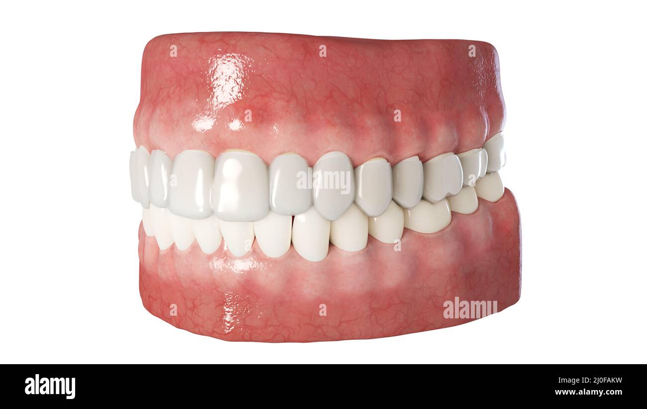 Clear dental aligner, illustration Stock Photo - Alamy