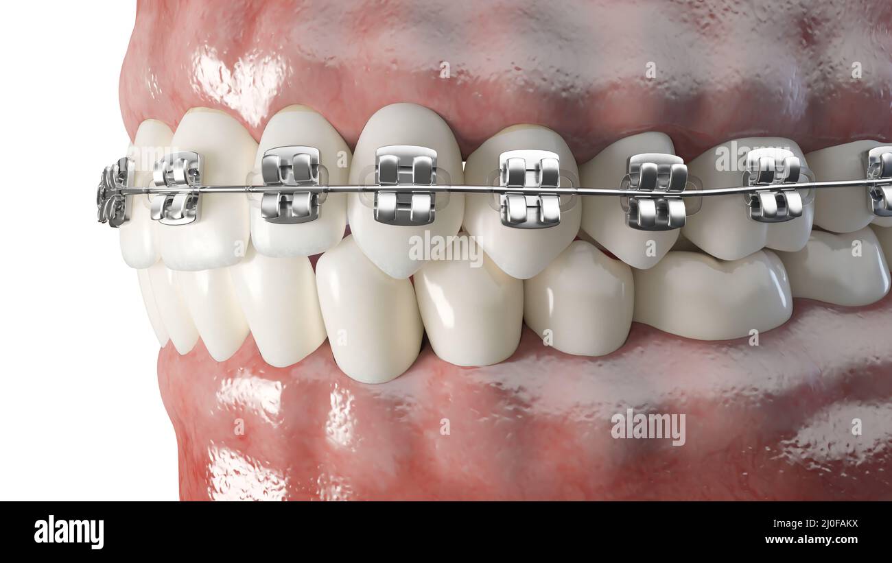 Dental braces, illustration Stock Photo - Alamy
