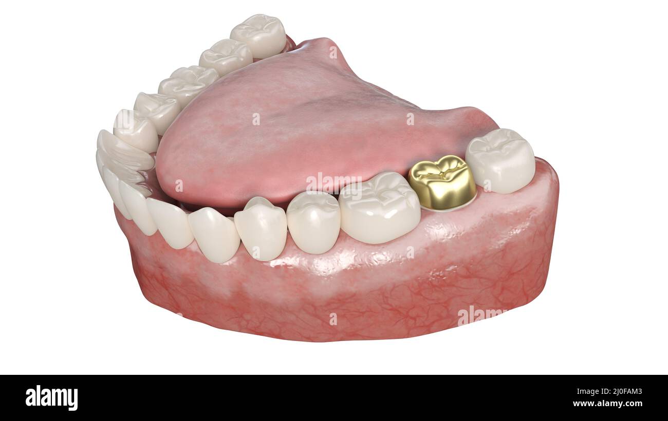 Gold tooth crown Cut Out Stock Images & Pictures - Alamy