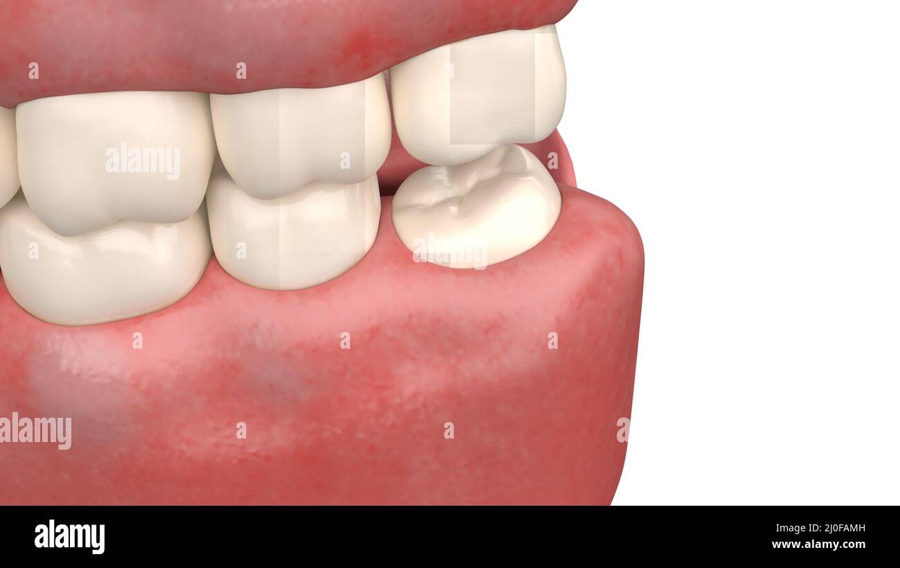 Impacted wisdom tooth, illustration Stock Photo - Alamy