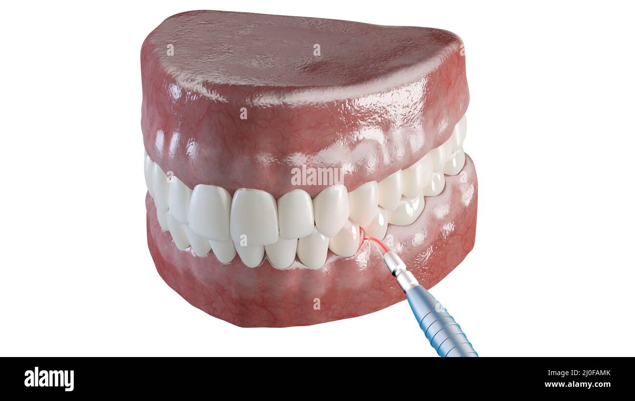 Gum correction, illustration Stock Photo - Alamy