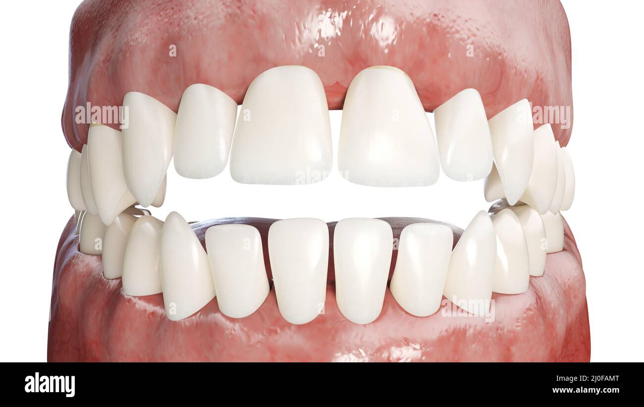 Open bite, illustration Stock Photo - Alamy