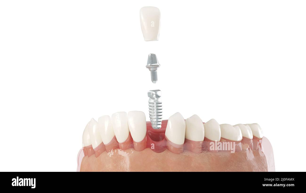 Dental implant, illustration Stock Photo - Alamy