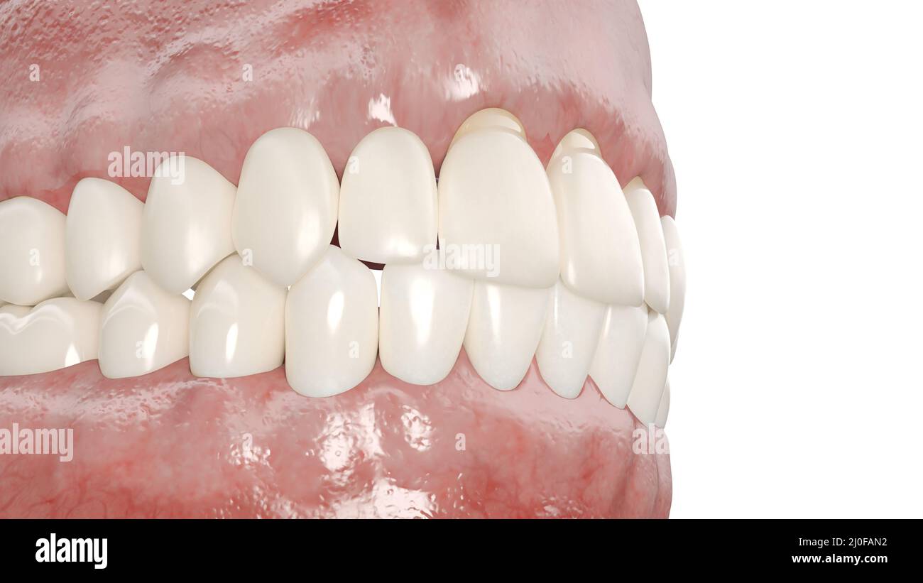 Gum recession hi-res stock photography and images - Alamy