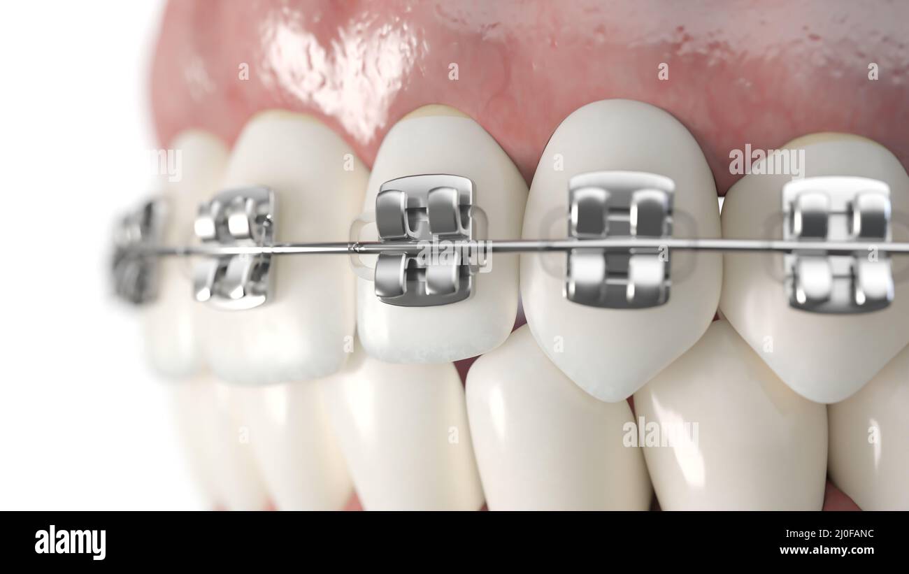 Braces nobody hi-res stock photography and images - Alamy