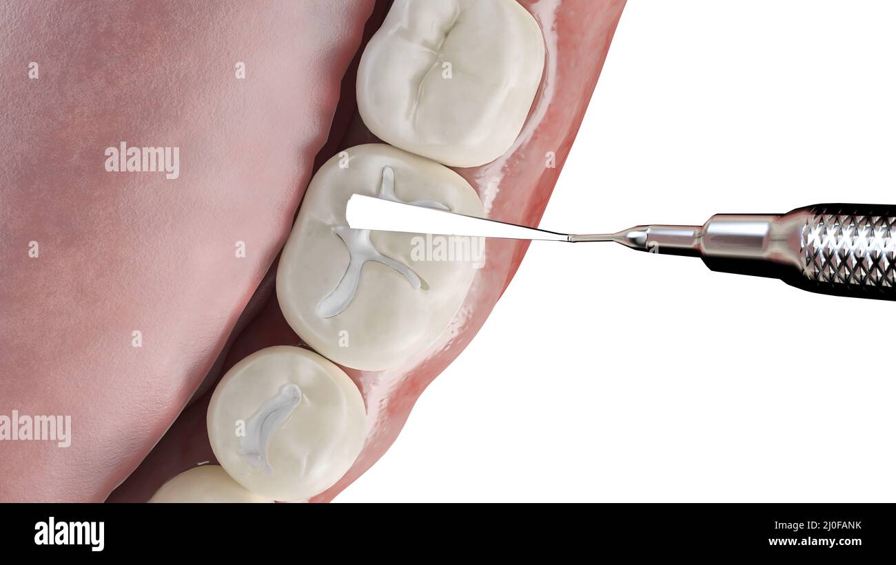 Dental fissure filling, illustration Stock Photo - Alamy