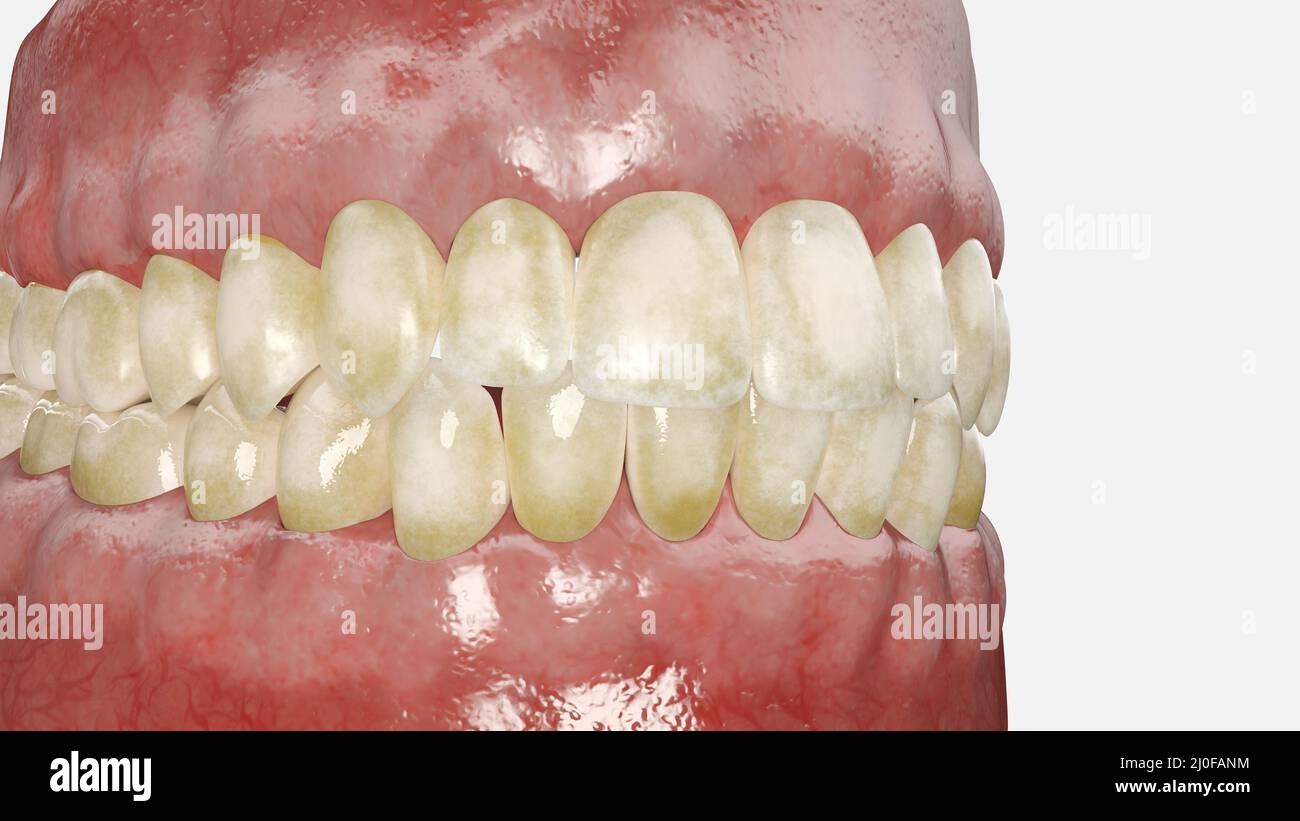 Dirty teeth, illustration Stock Photo - Alamy