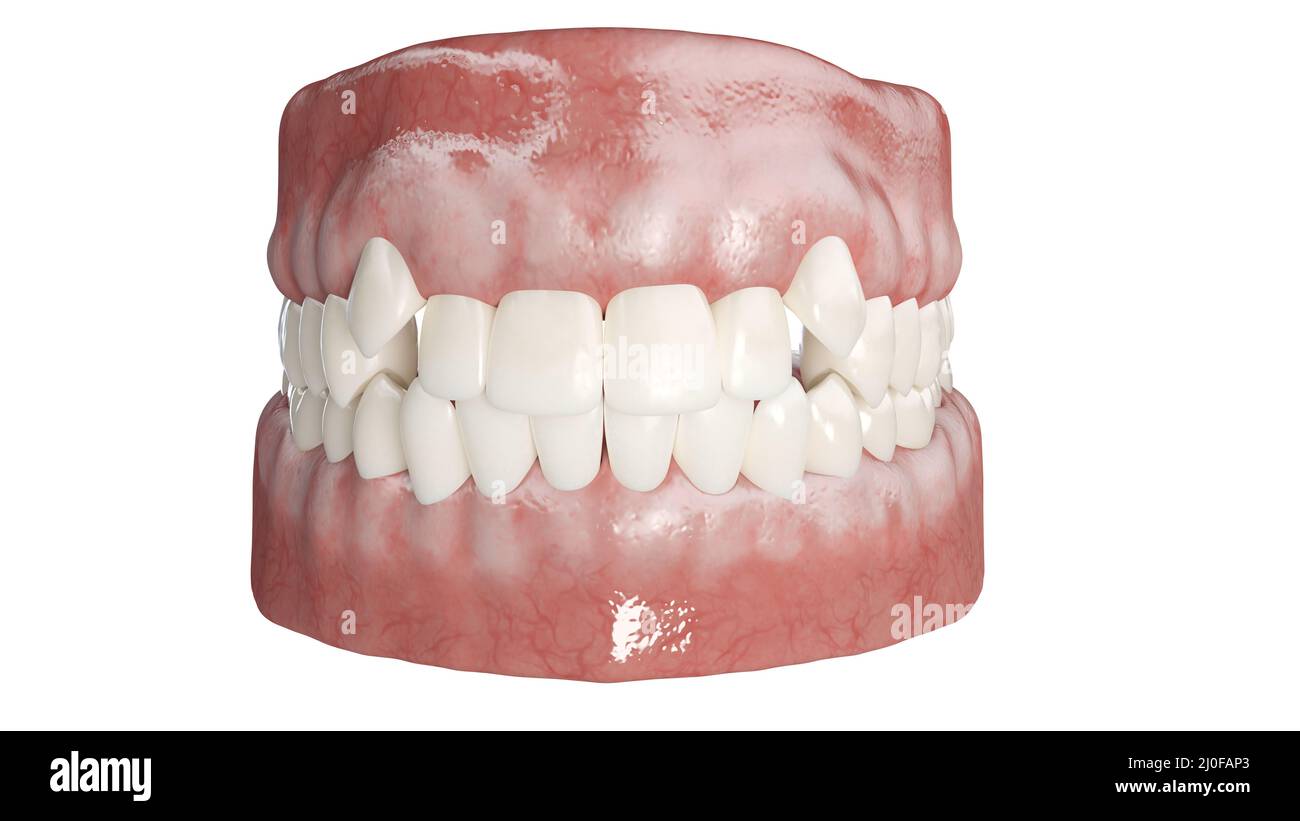 Impacted Front Teeth