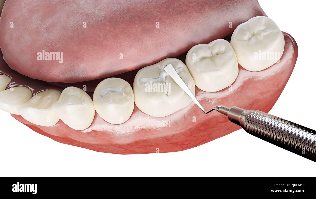 Tooth filling isolated hi-res stock photography and images - Alamy